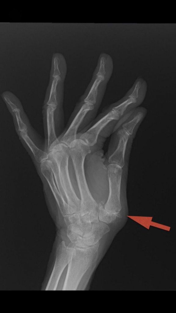 Dr. Fernando Polo | Rizartrosis